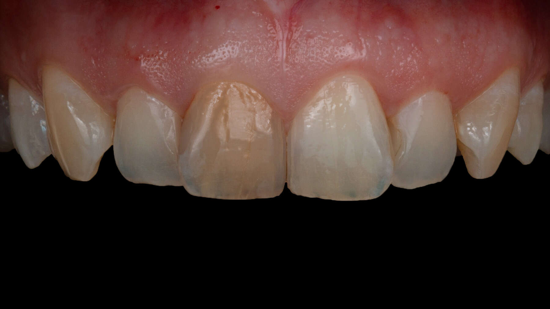 Internal bleaching of endodontically treated teeth: Technique and ...
