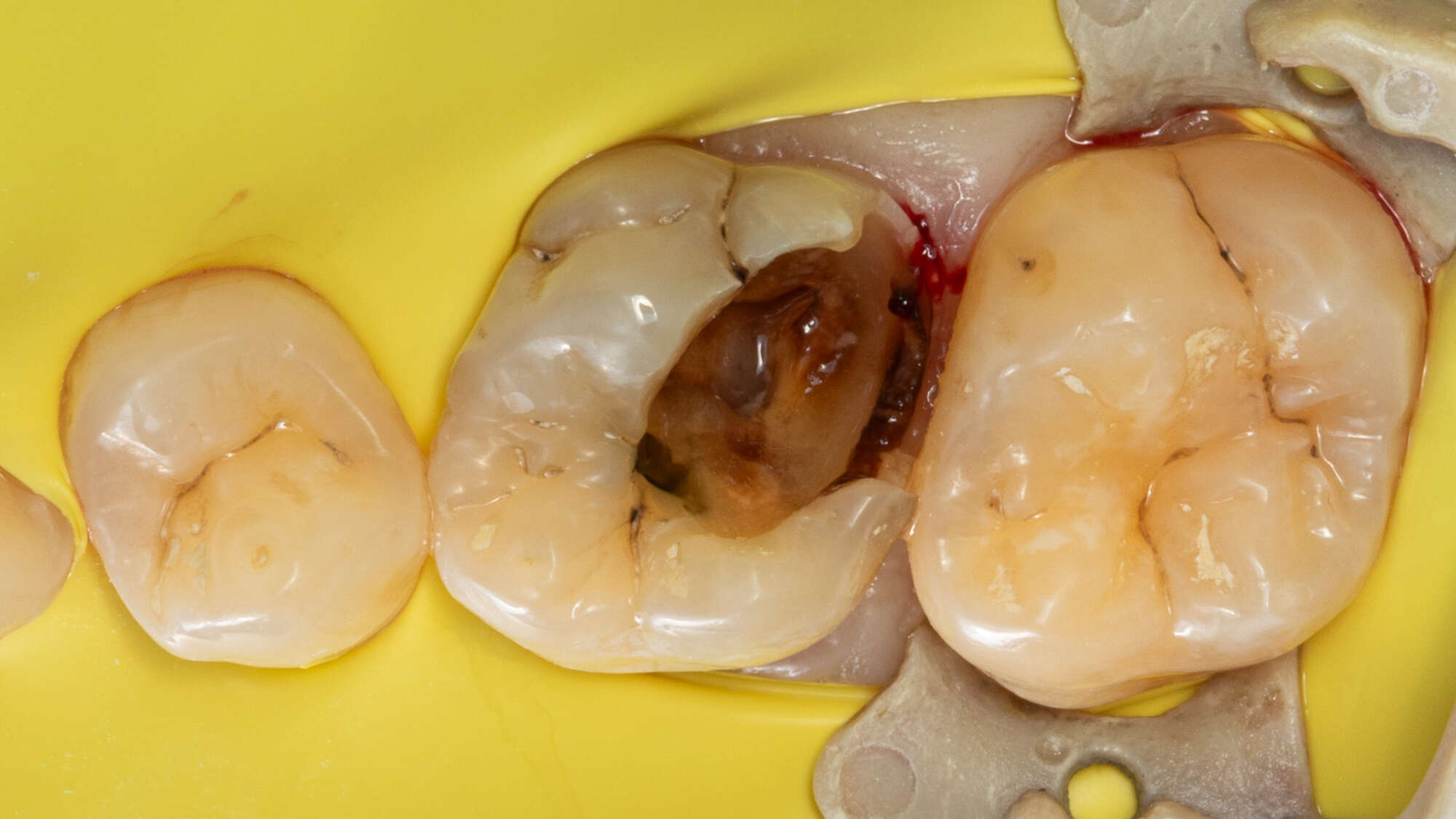 Provisional pre-endodontic restoration