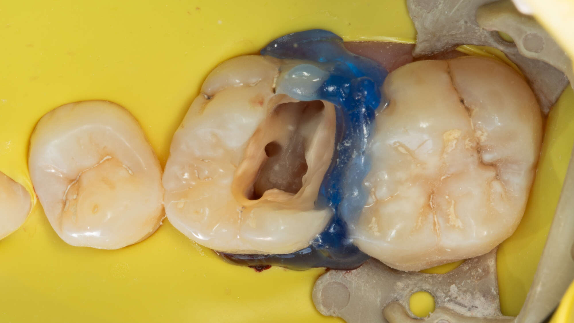 Provisional pre-endodontic restoration